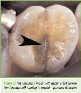 Tooth Fractures